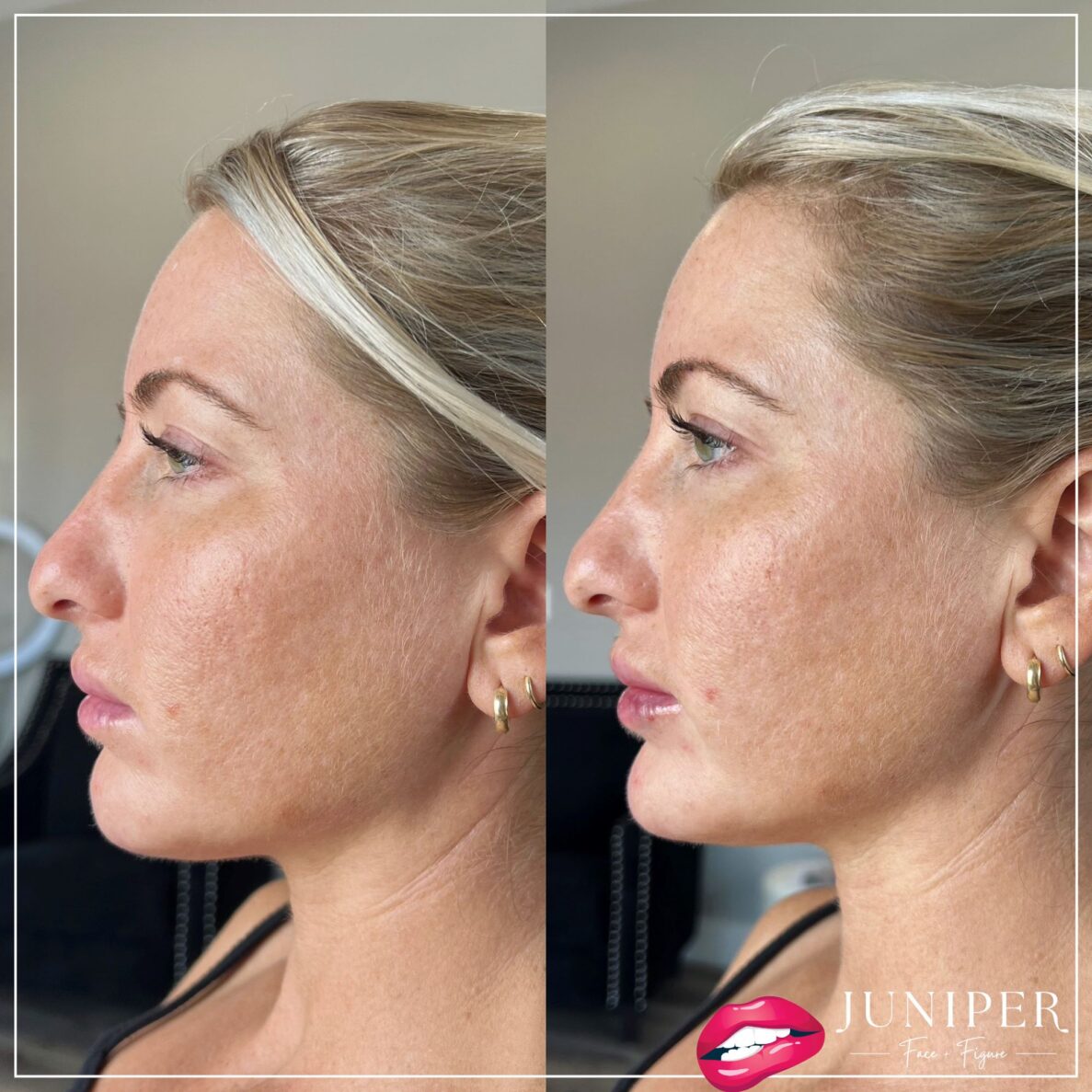 Fillers | Juniper Face + Figure