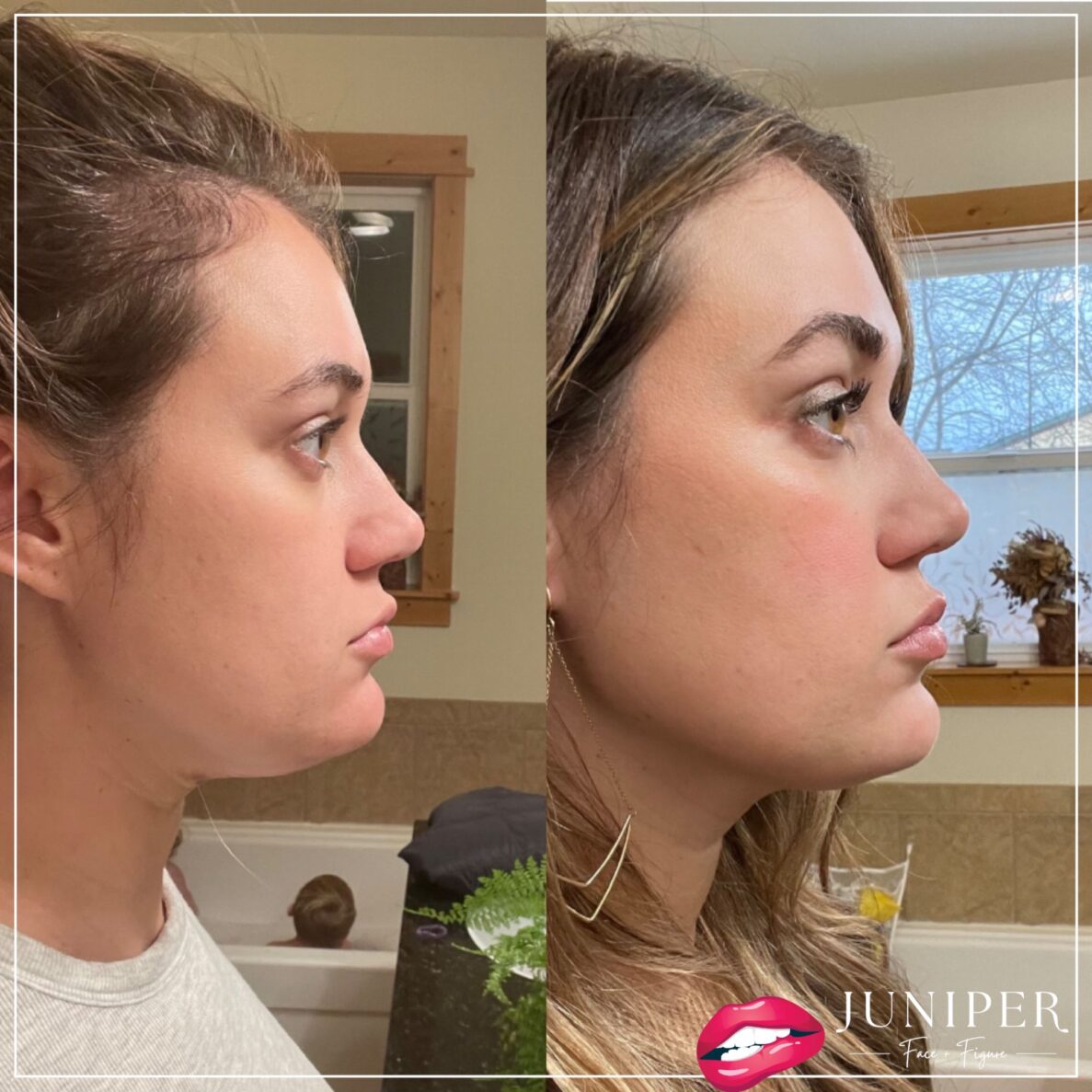 Kybella, Patient 2 - Juniper Face + Figure