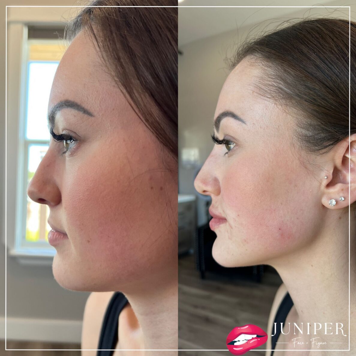 Fillers | Juniper Face + Figure