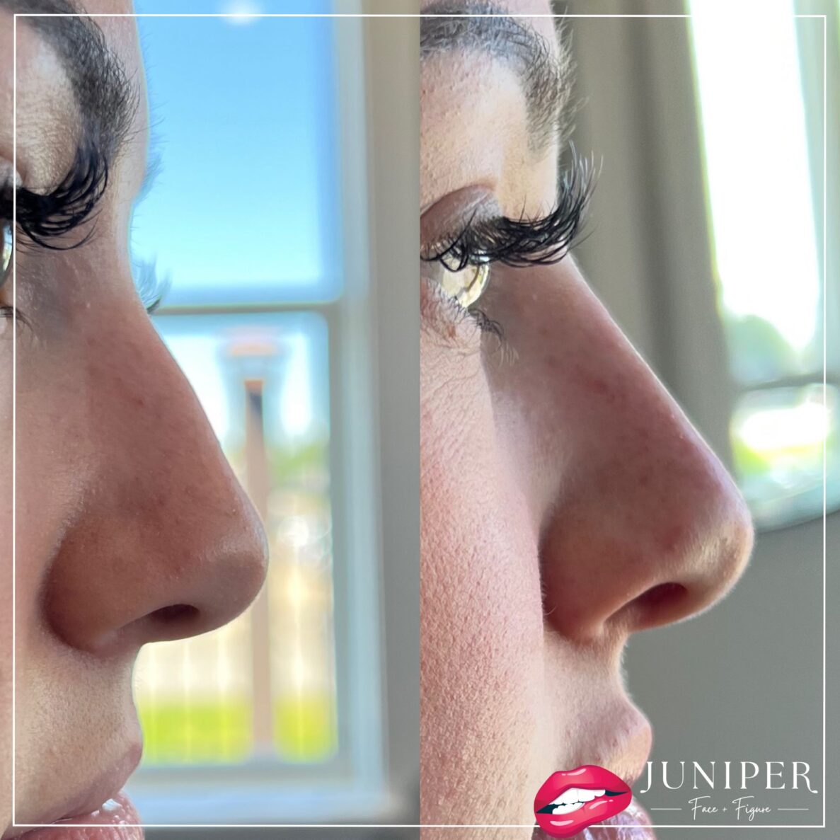 Non-Surgical Nose Job, #5 - Juniper Face + Figure