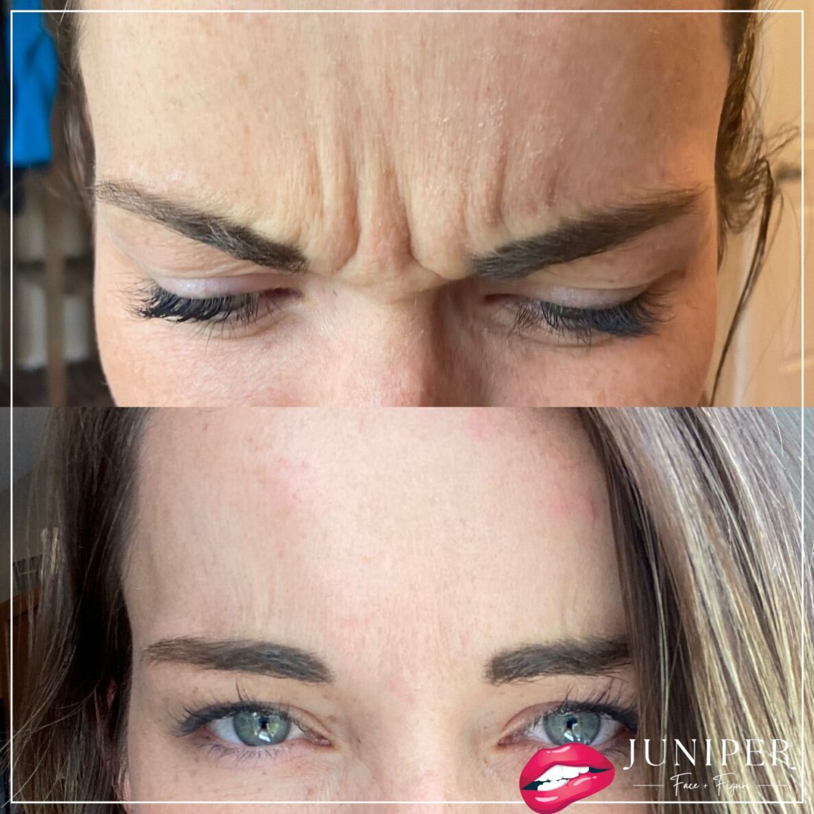 Botox + Jeuveau | Juniper Face + Figure