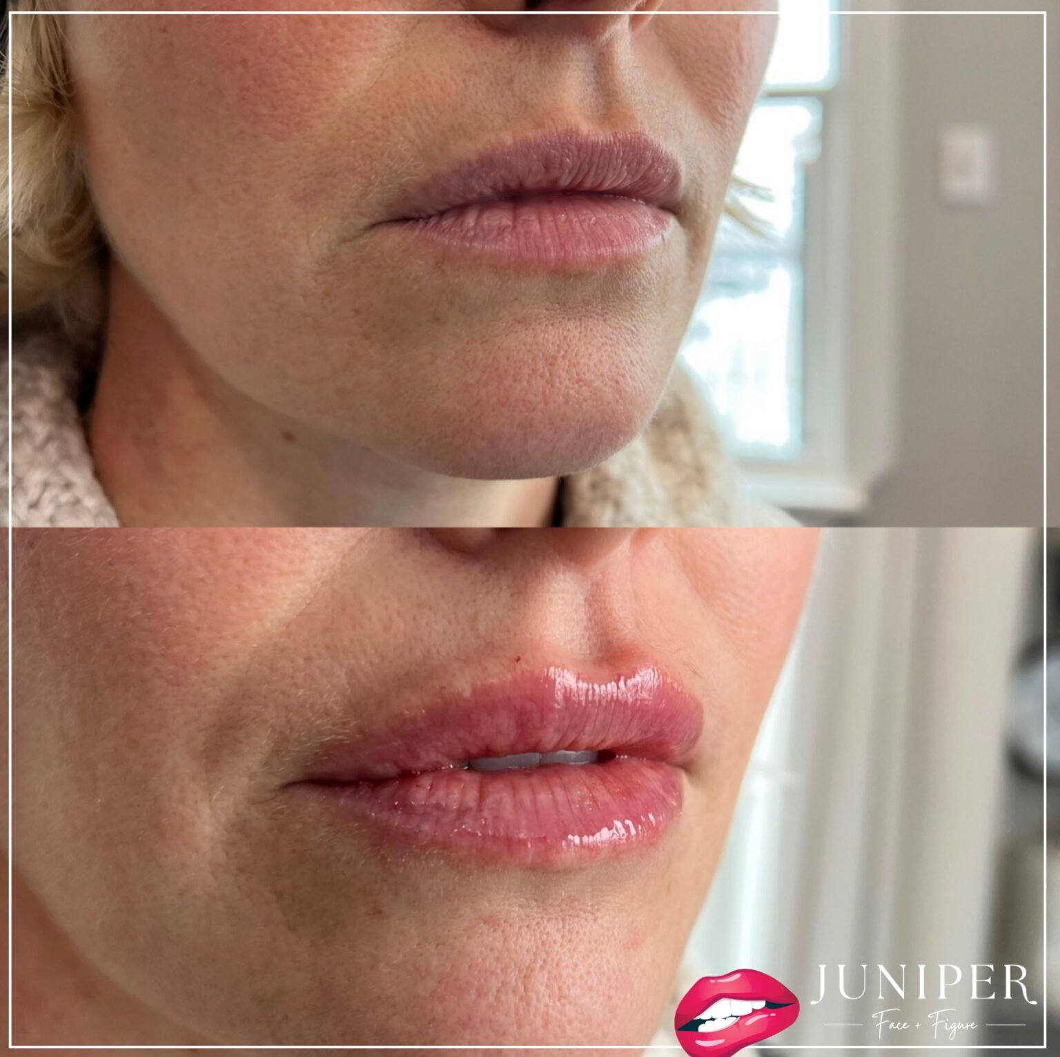 Fillers | Juniper Face + Figure