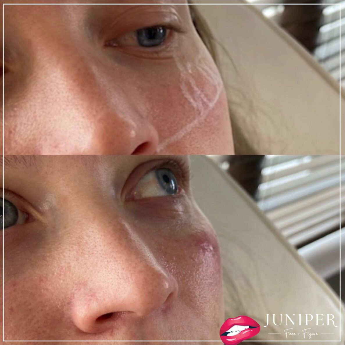 Cheek Enhancement, #1 - Juniper Face + Figure