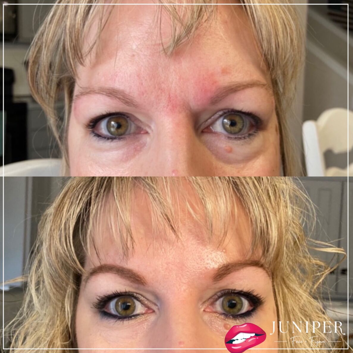 Eyebrow Lift, #1 - Juniper Face + Figure