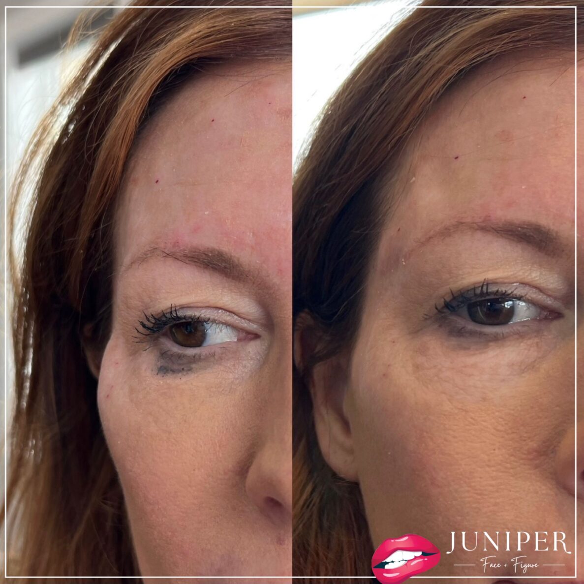 Fillers | Juniper Face + Figure