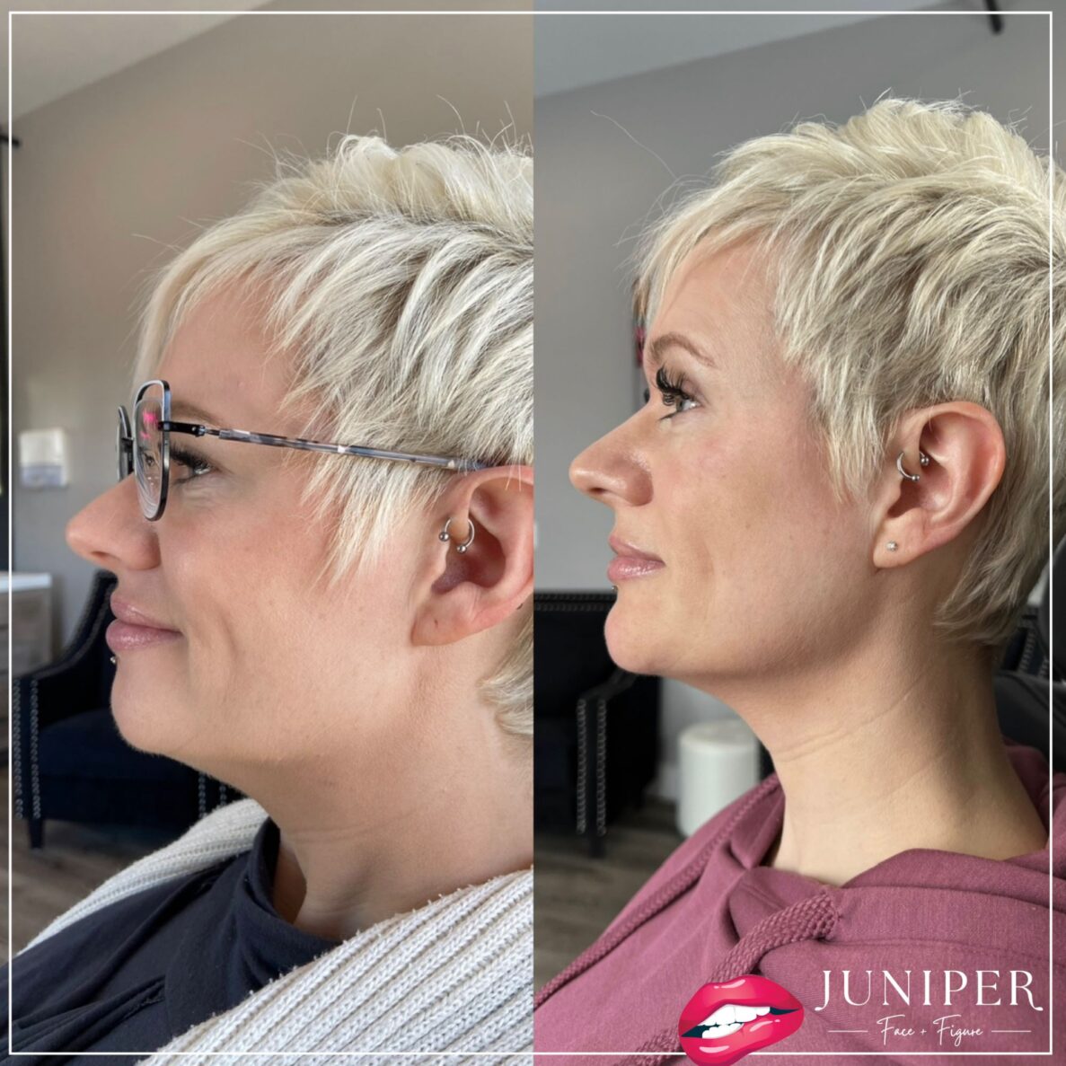 Chin Enhancement, #3 - Juniper Face + Figure