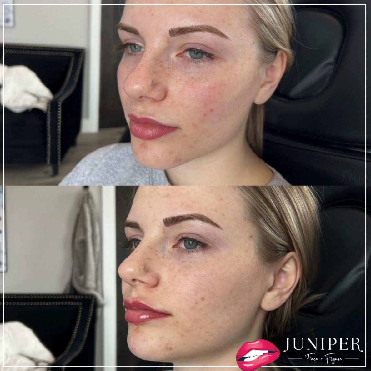Fillers | Juniper Face + Figure