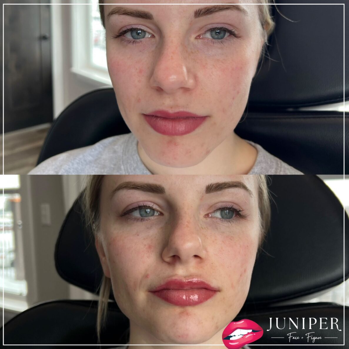 Fillers | Juniper Face + Figure