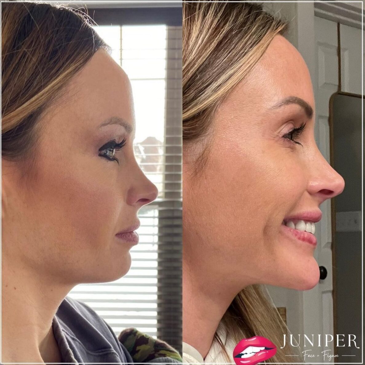 Chin Enhancement, #4 - Juniper Face + Figure
