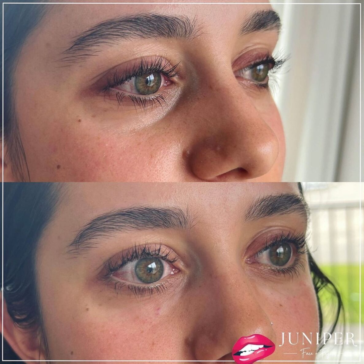 Fillers | Juniper Face + Figure