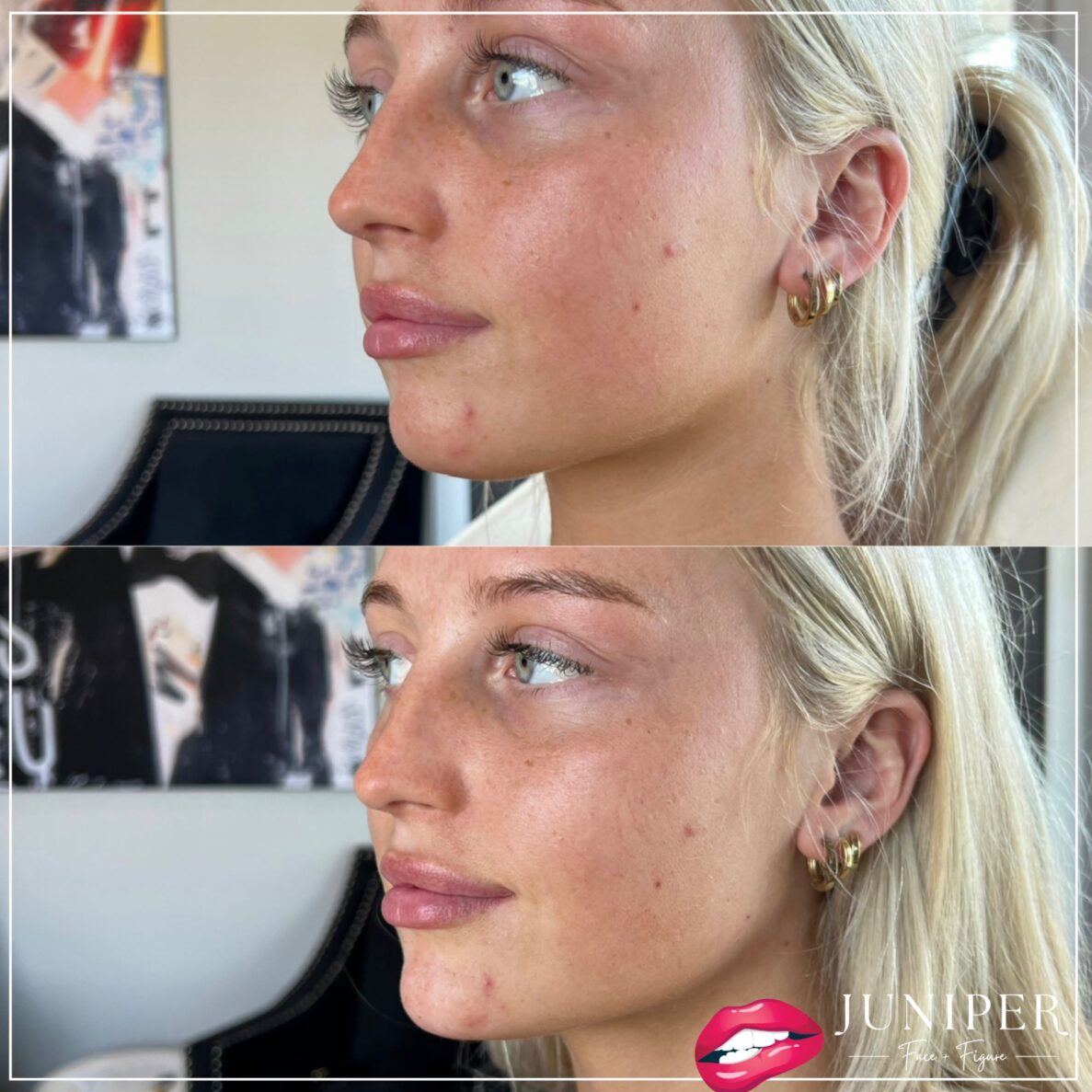 Fillers | Juniper Face + Figure