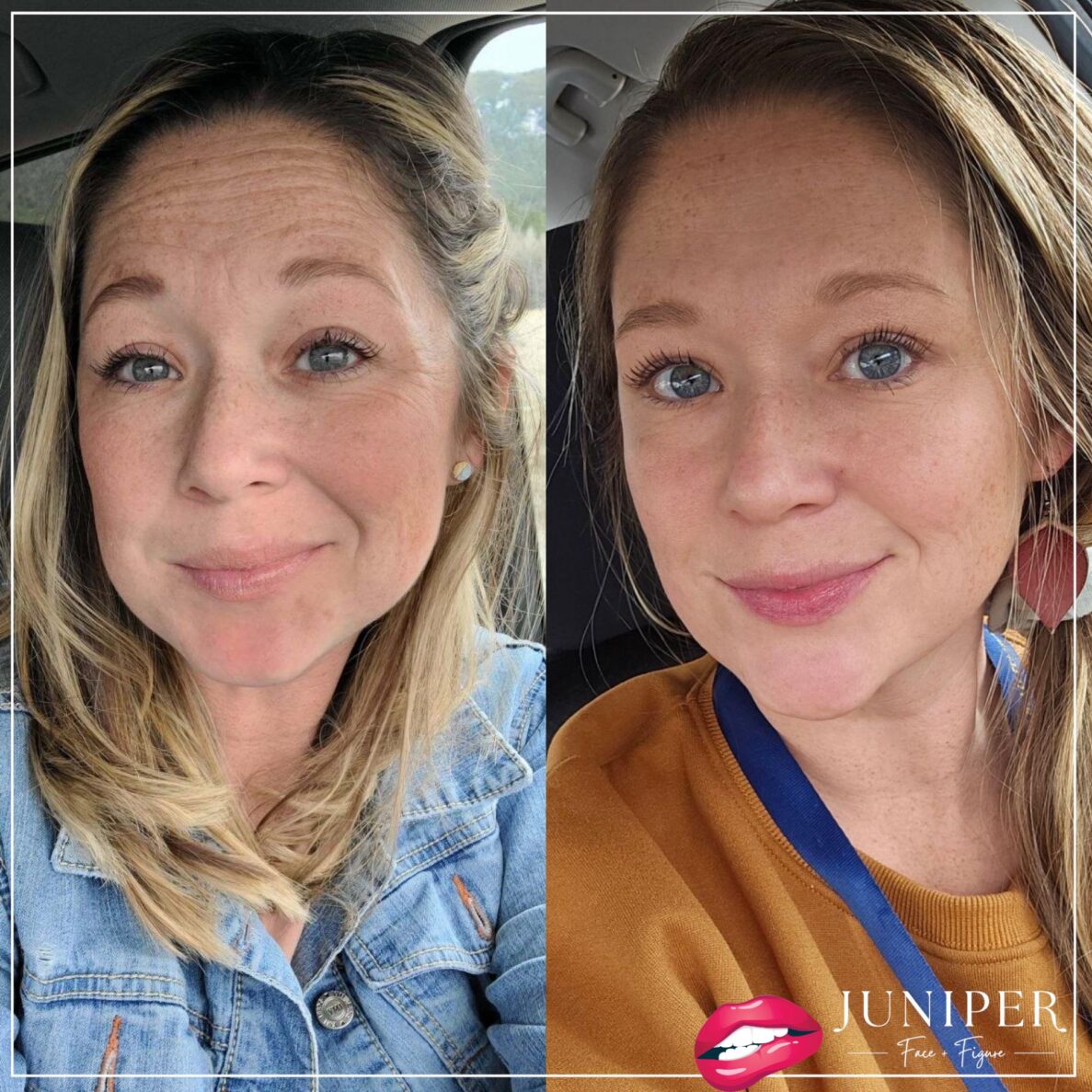 Botox + Jeuveau | Juniper Face + Figure
