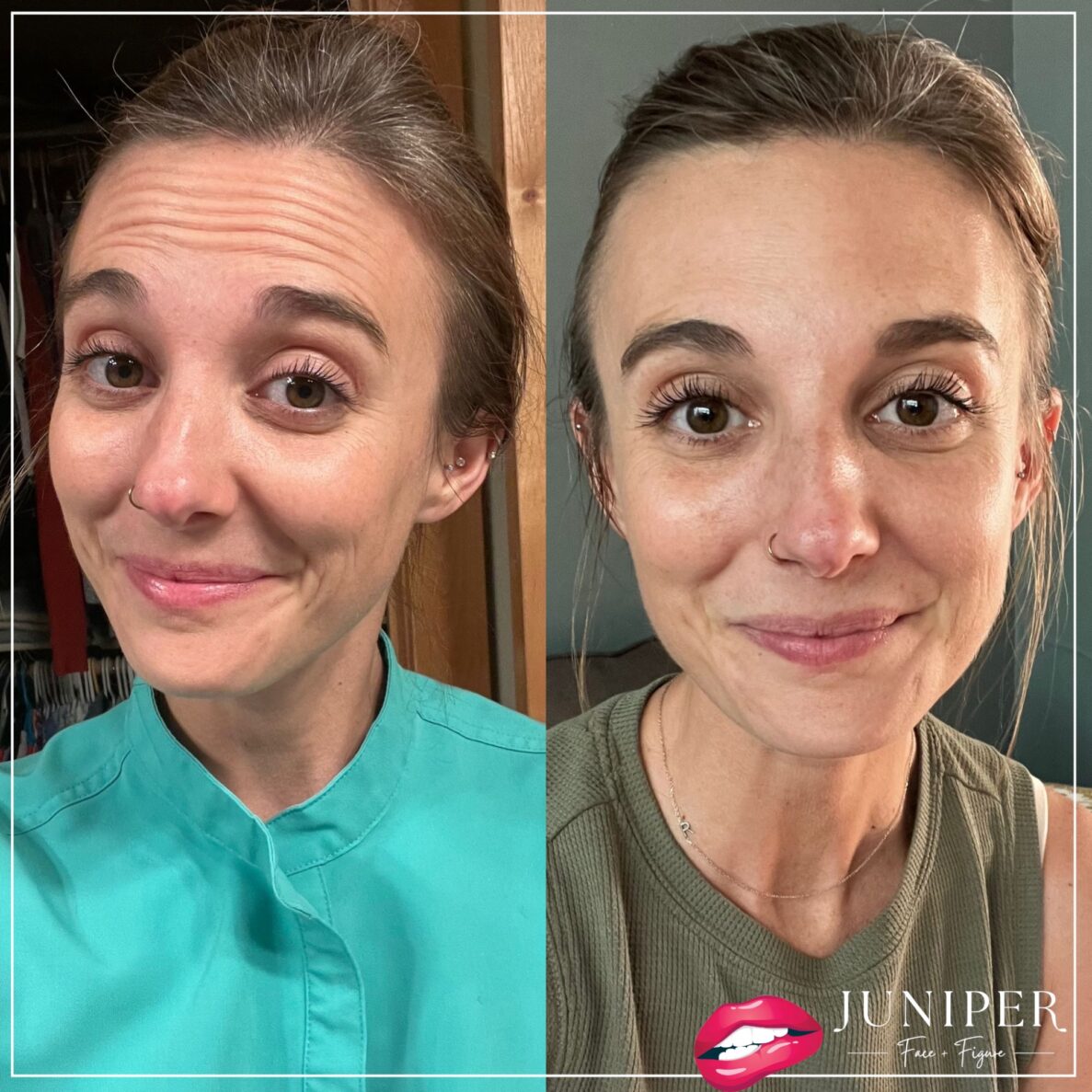 Botox + Jeuveau | Juniper Face + Figure