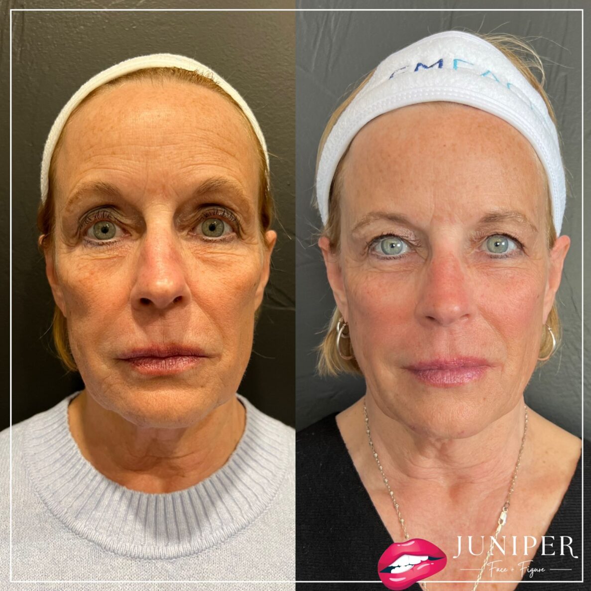 Emface | Juniper Face + Figure