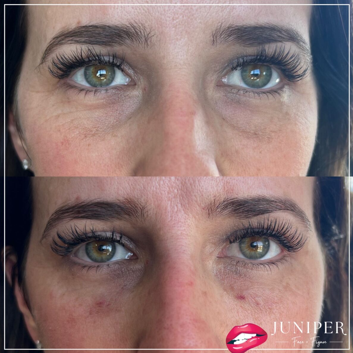 Under Eye (Bags, Hollows, and Tear Troughs), #13 - Juniper Face + Figure