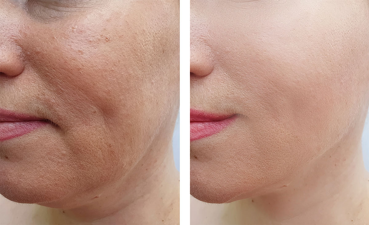 ClearRF: Treats Sun Spots, Age Spots, Hyperpigmentation, + Facial ...