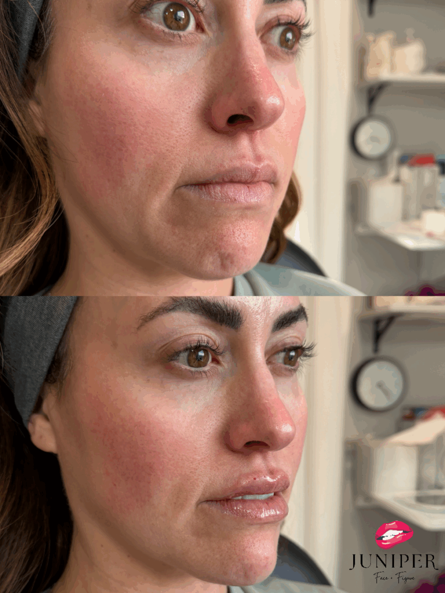 Before and After Jawline - Juniper Face + Figure